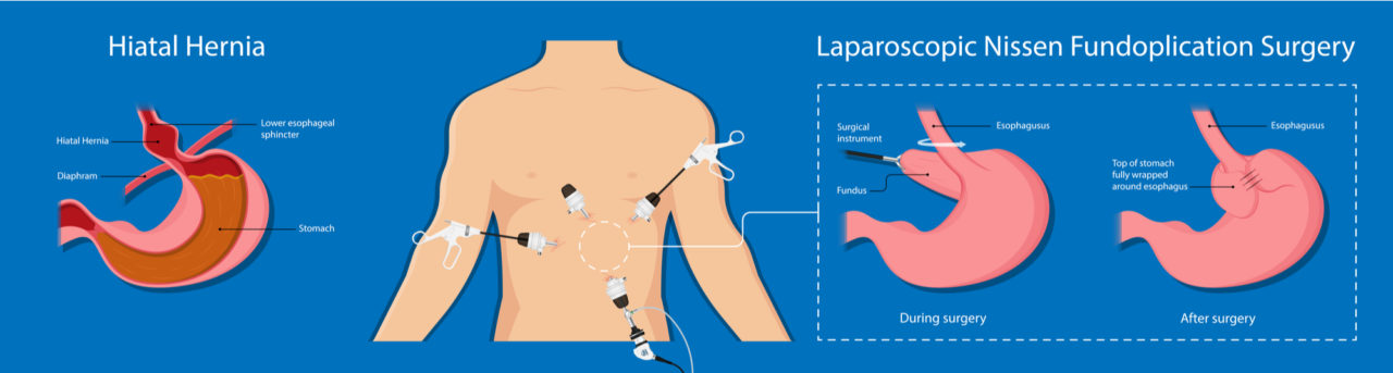 Hiatal Hernia & Acid Reflux Symptoms | The Surgical Clinic