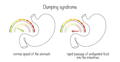 Dumping Syndrome After Bariatric Surgery | Symptoms & Treatment ...